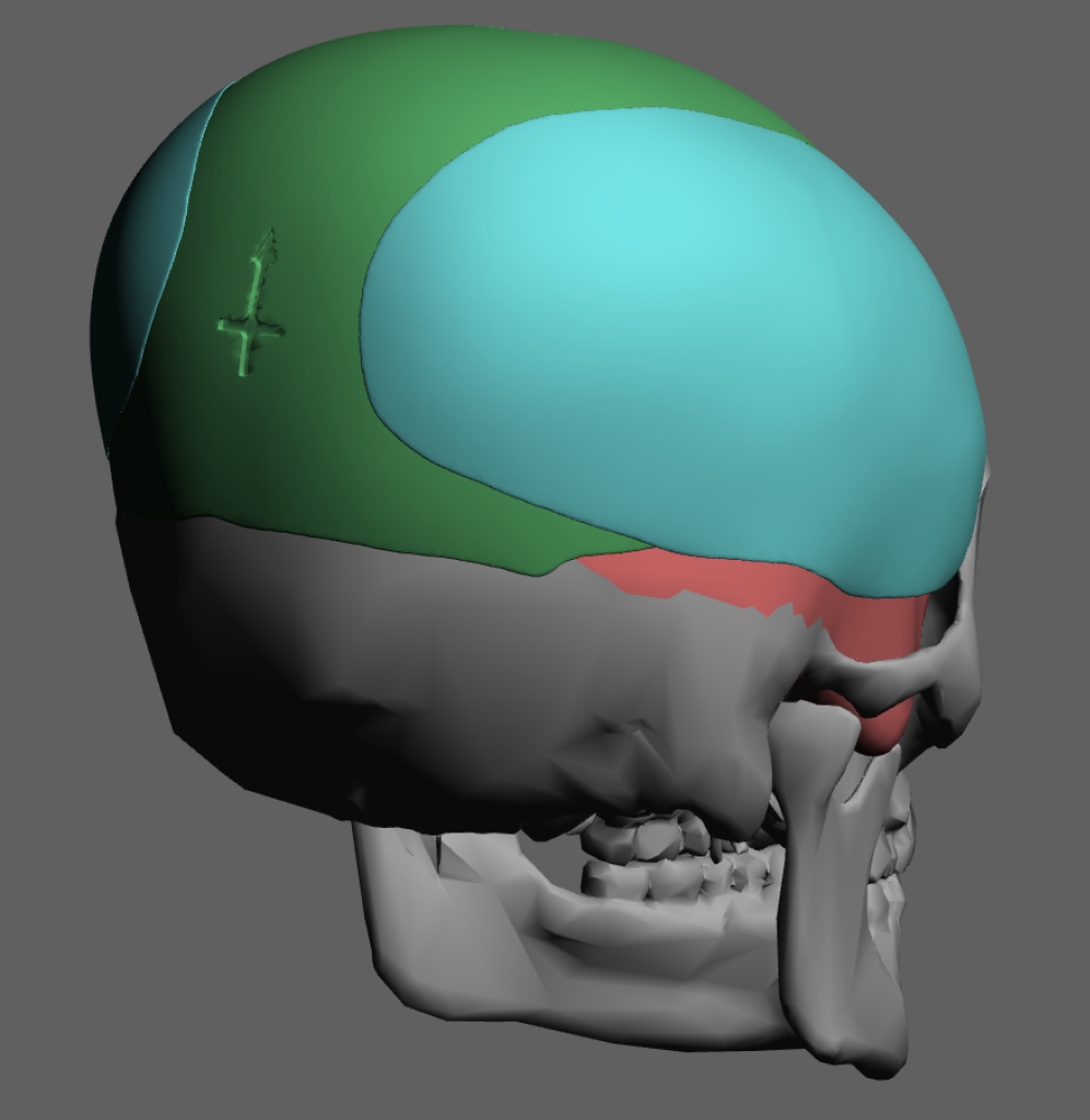 Plastic Surgery Case Study - Custom Extended Temporal-Forehead Implants ...