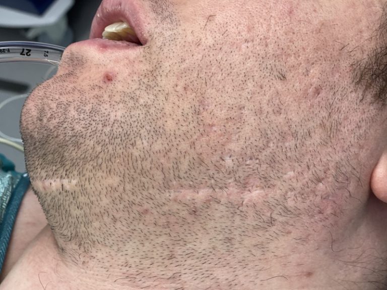 Transcutaneous Medpor jaw implant palcement scars. - Explore Plastic ...