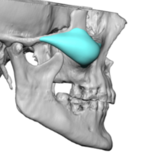 Plastic Surgery Case Study - Replacing Ancient Cheek Implants with New ...