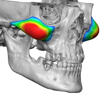 Plastic Surgery Case Study - Replacing Ancient Cheek Implants with New ...