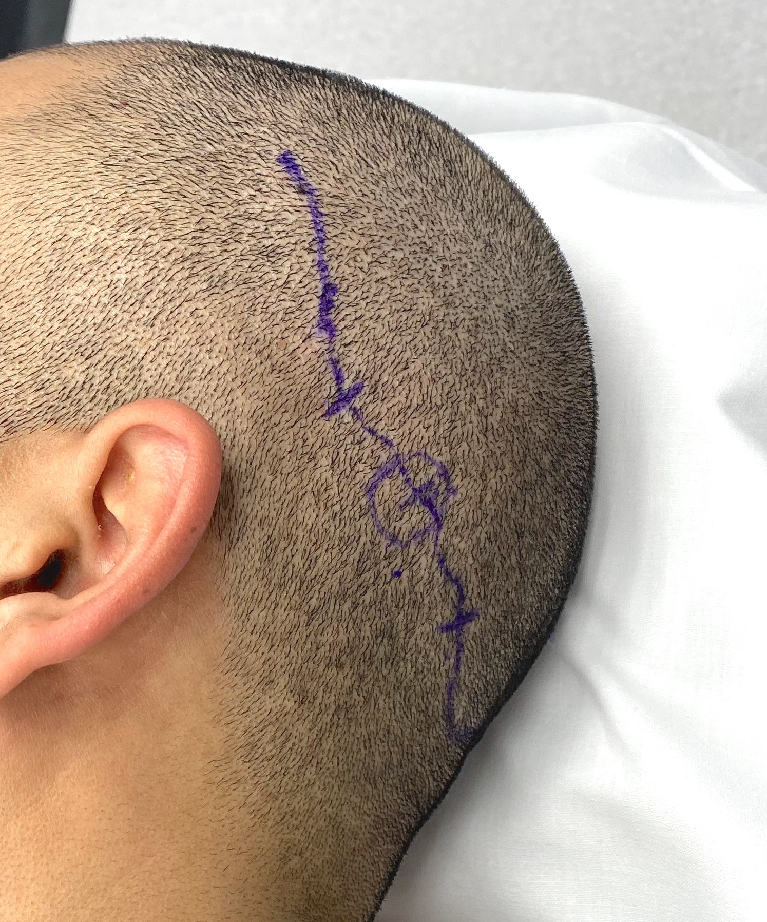 Technical Strategies - Custom Skull Implant Capsulotomies for Implant ...