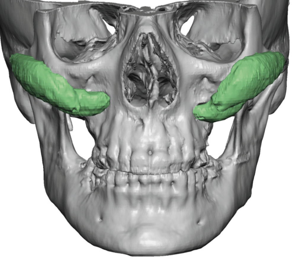 existing double cheek implants 3D CT scan Dr Barry Eppley Indianapolis ...