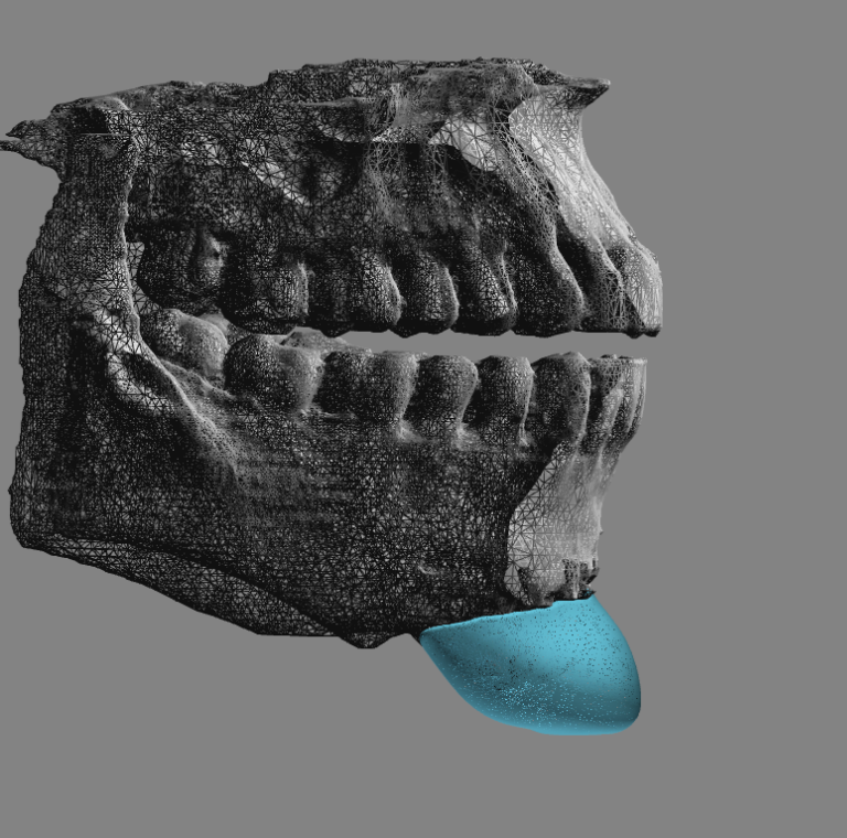 Plastic Surgery Case Study - Female Custom Chin Implant for a Tapered V ...