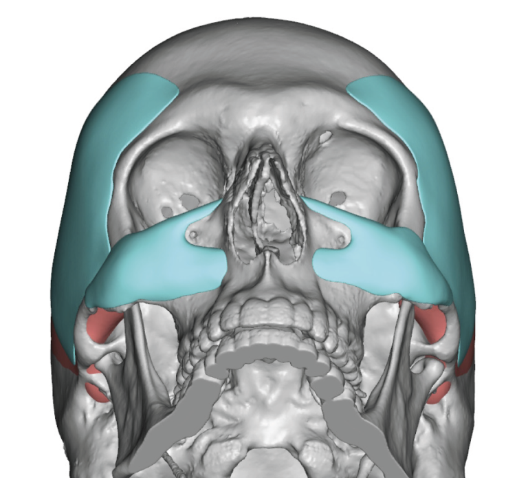 Plastic Surgery Case Study - Augmenting the Thin Face with Combined ...