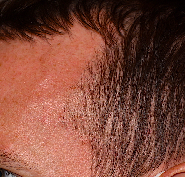 male left prominent temporal arteries Dr Barry Eppley Indianapolis ...