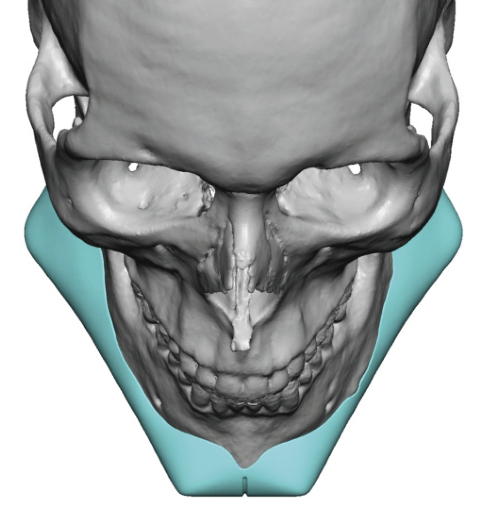 The Midline Marker Positioning Aid in Custom Jawline Implants - Explore ...