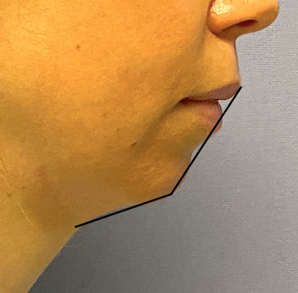 Plastic Surgery Case Study - The Sliding Genioplasty and Submental ...