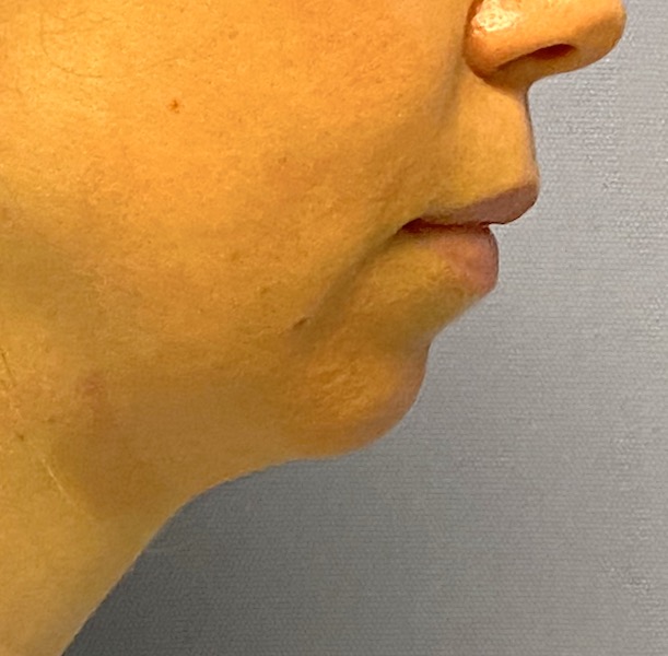 Plastic Surgery Case Study - The Sliding Genioplasty and Submental ...