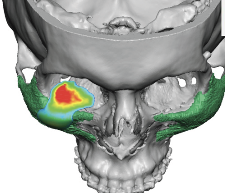 Plastic Surgery Case Study - Custom Orbital Floor-Rim Implant in the ...