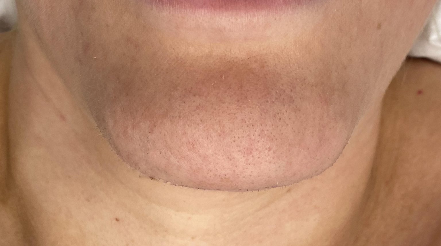 Plastic Surgery Case Study - Tertiary (3rd) Female Chin Reduction by a ...