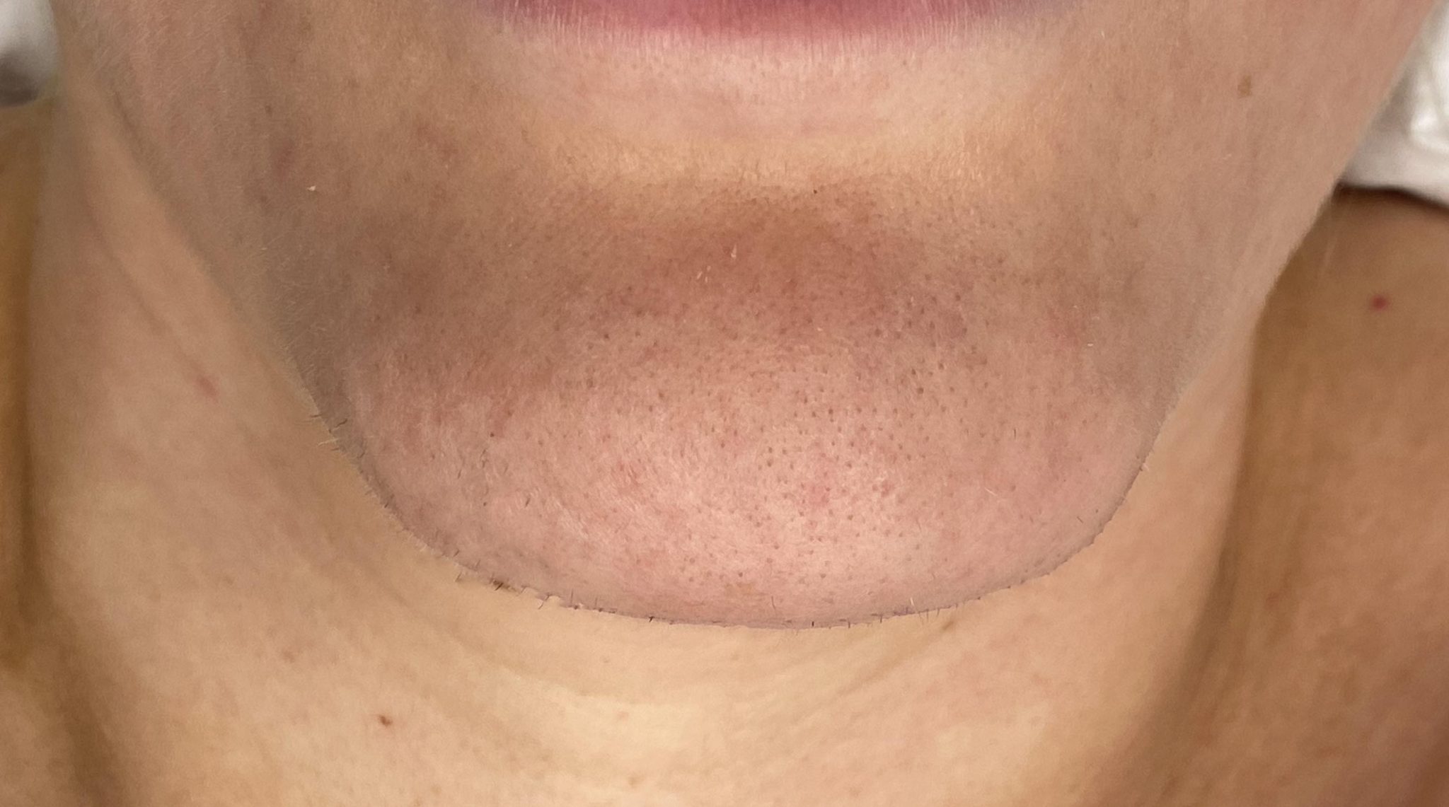 Plastic Surgery Case Study - Tertiary (3rd) Female Chin Reduction by a ...