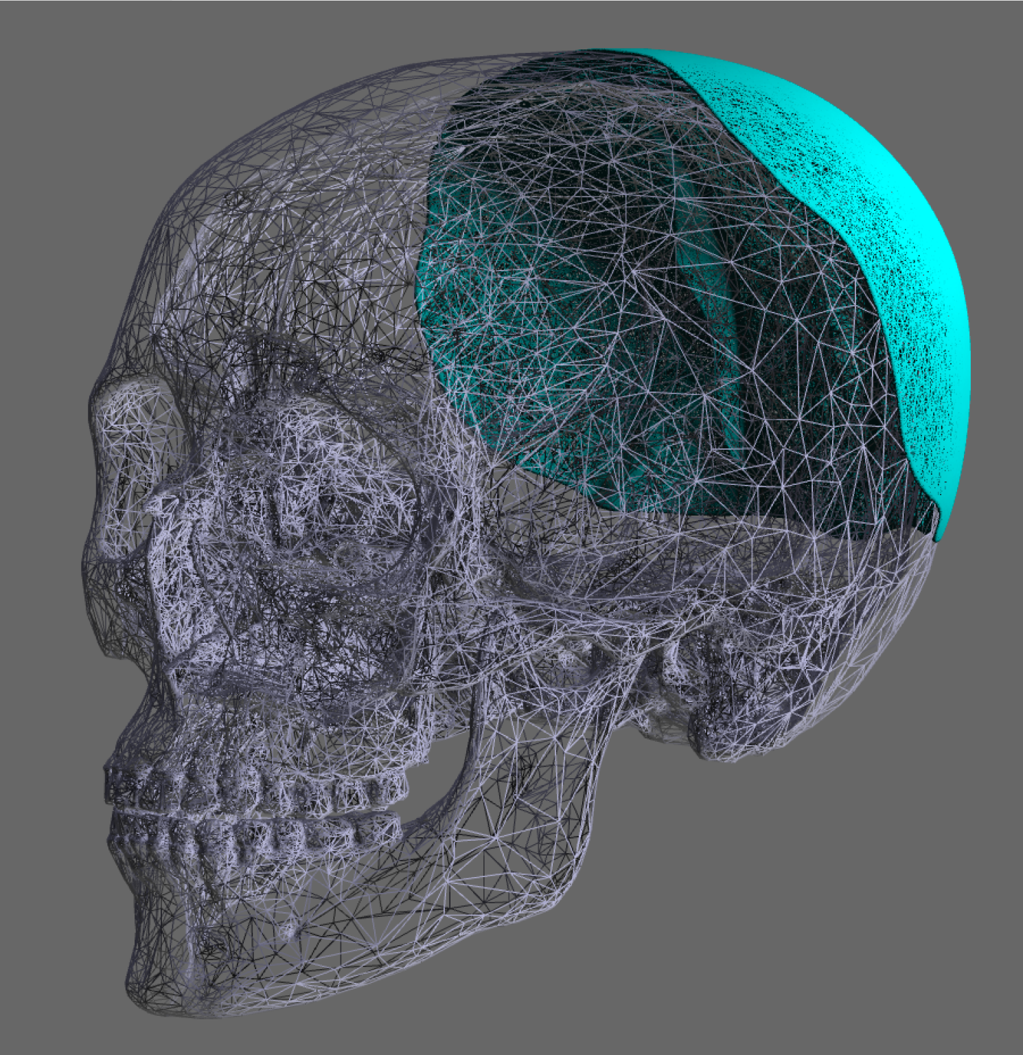 Plastic Surgery Case Study - The Saturn Custom Skull Implant for Female ...