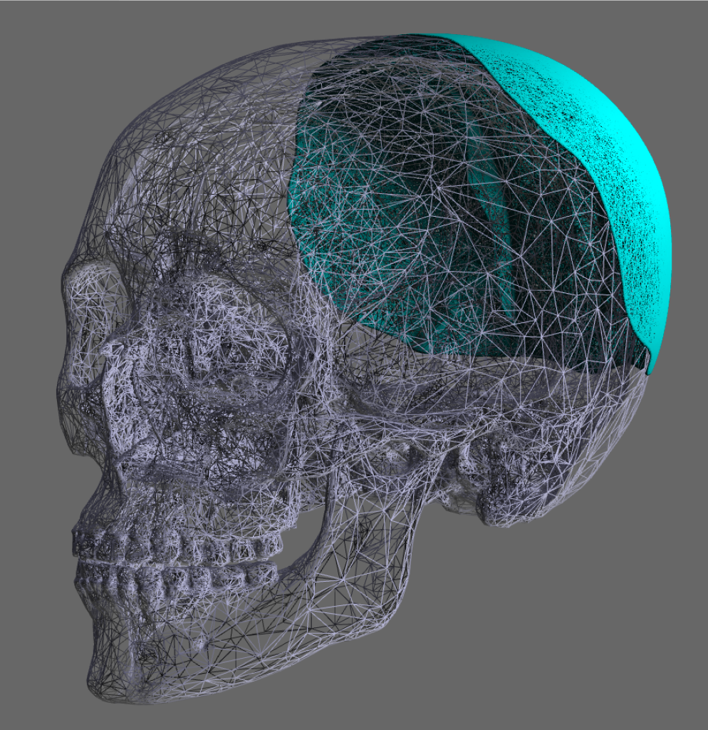 Plastic Surgery Case Study - The Saturn Custom Skull Implant for Female ...