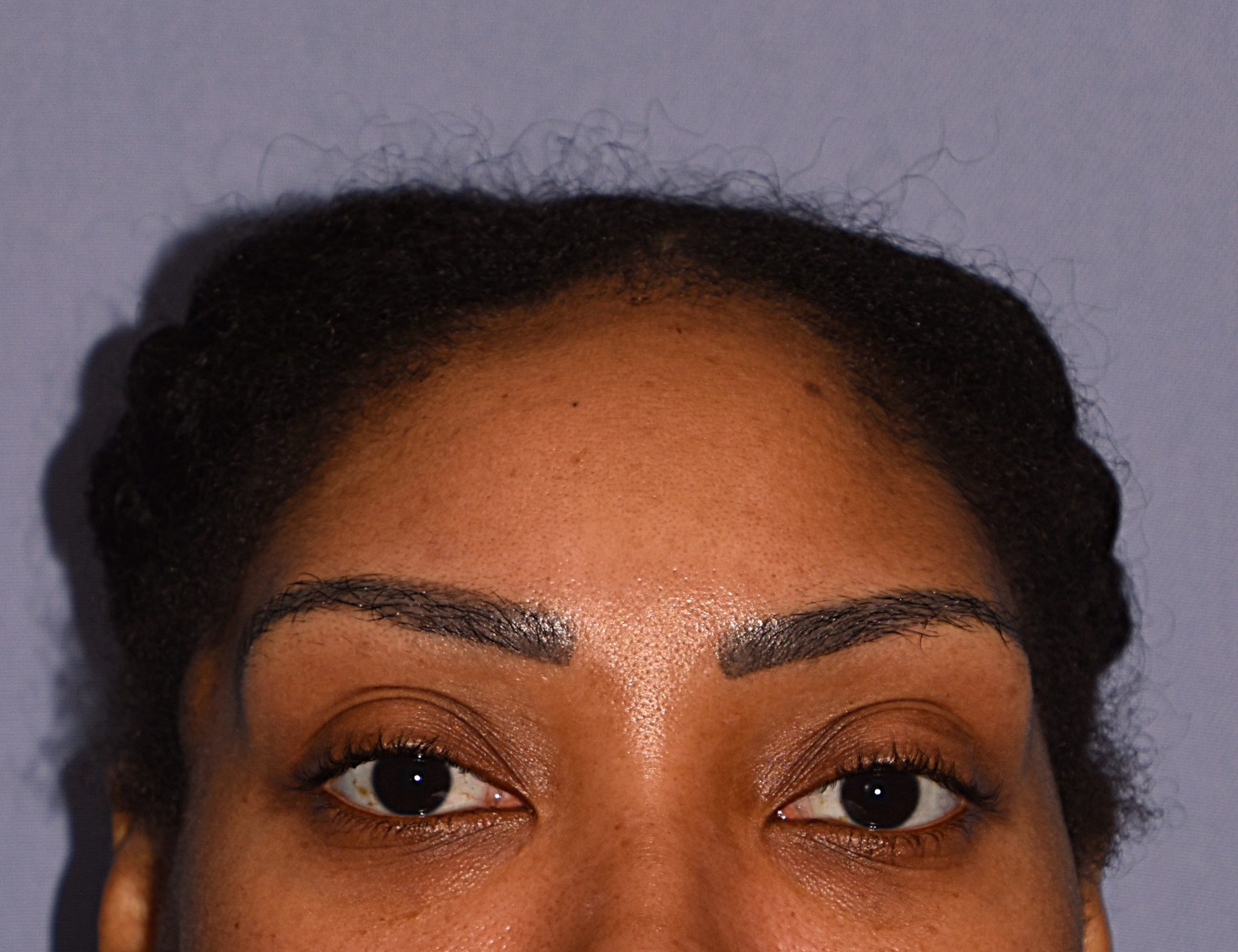 female skull deformity frnt 1 Dr Barry Eppley Indianapolis - Explore ...