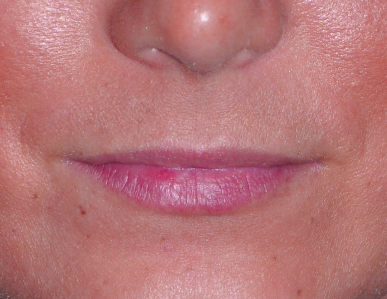 Long Term Outcomes of the Subnasal Lip Lift - Explore Plastic Surgery