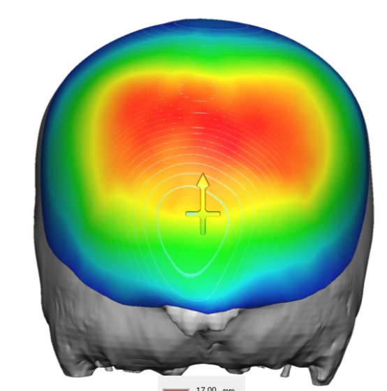 Basic Concepts in Flat Back of Head Custom Skull Implant Designs ...