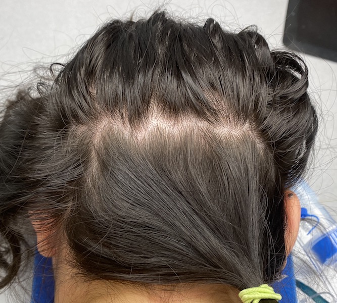 hair parting scalp incision on bck of head Dr Barry Eppley Indianapolis ...