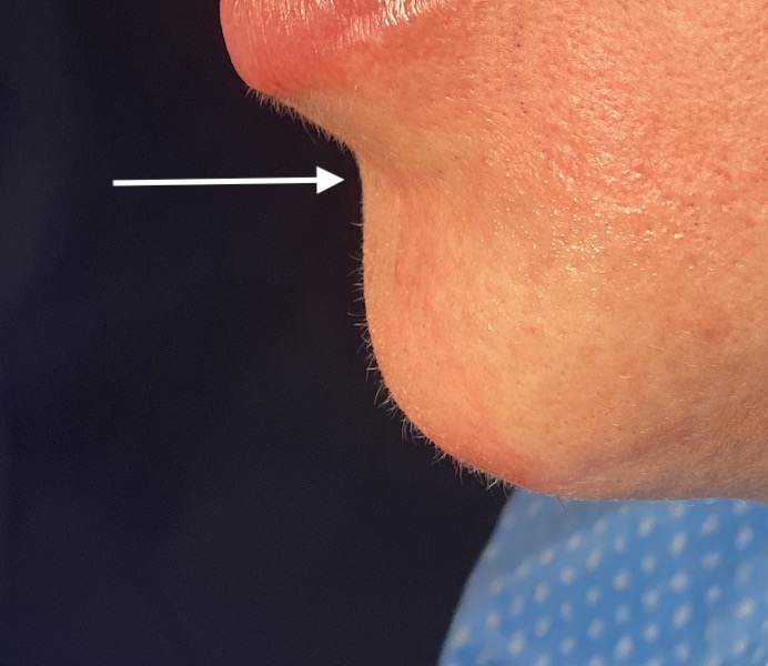Technical Strategies - Fat Injection Grafting of the Labiomental Fold ...