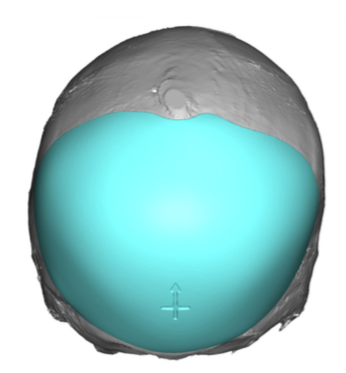 male back of head custom skull implant design back view Dr Barry Eppley ...