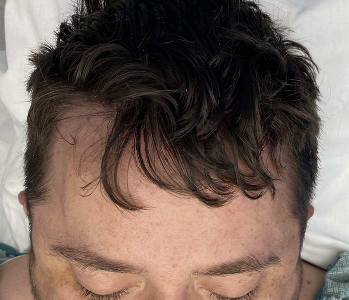 Plastic Surgery Case Study - Male Temporal Reduction for Head Width ...