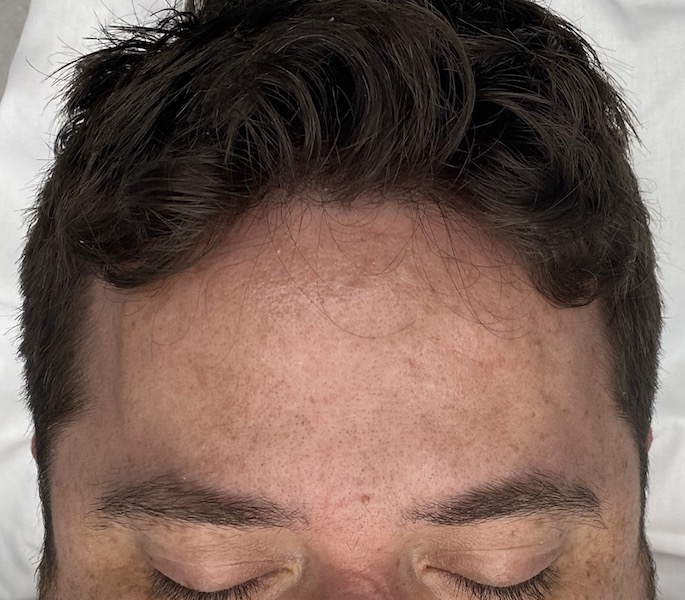 male temporal reductions front 1 Dr Barry Eppley Indianapolis - Explore ...