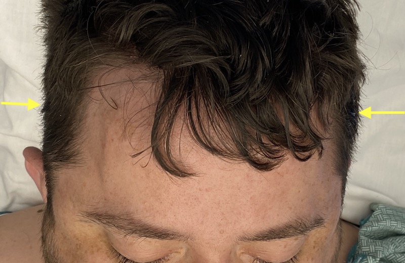 Plastic Surgery Case Study - Male Temporal Reduction for Head Width ...