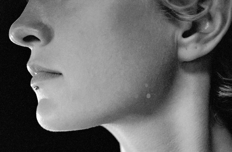 Botox Injections of the Lateral Pterygoid Muscle in Clenching (Bruxism ...