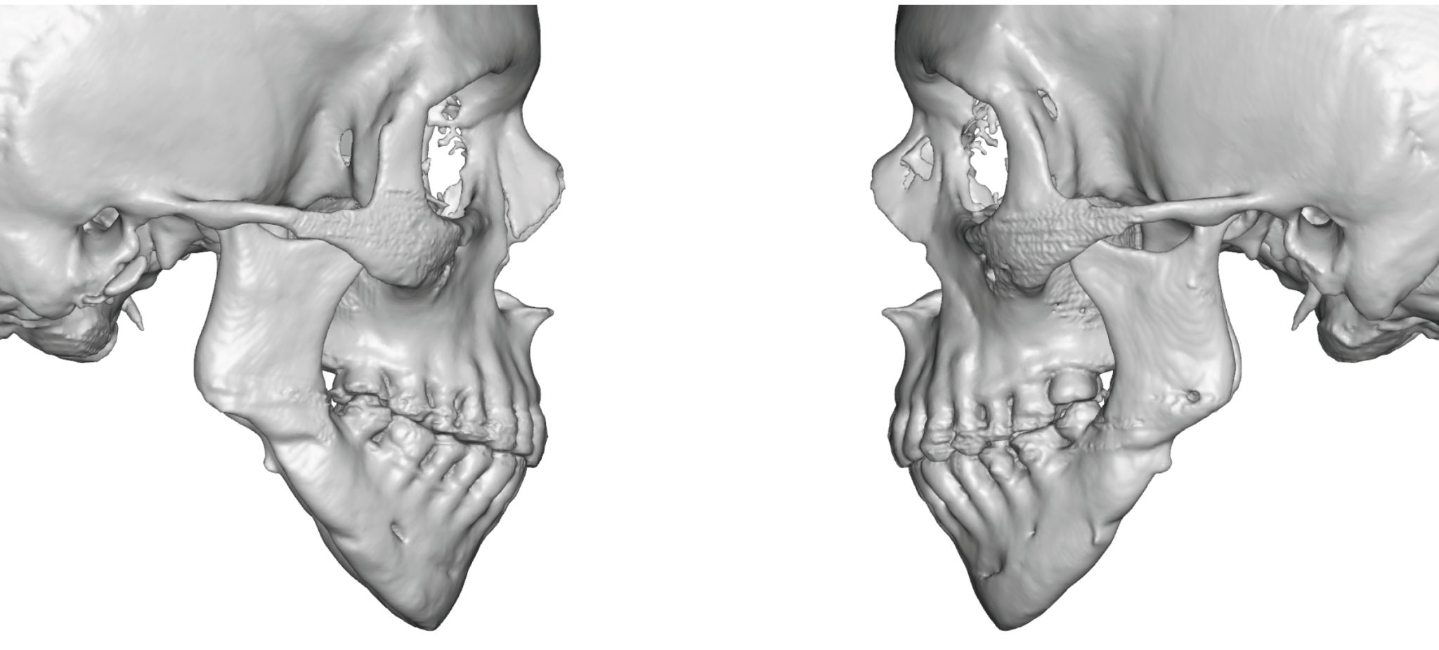 Plastic Surgery Case Study - Medpor Jaw Angle Implant Removals with ...