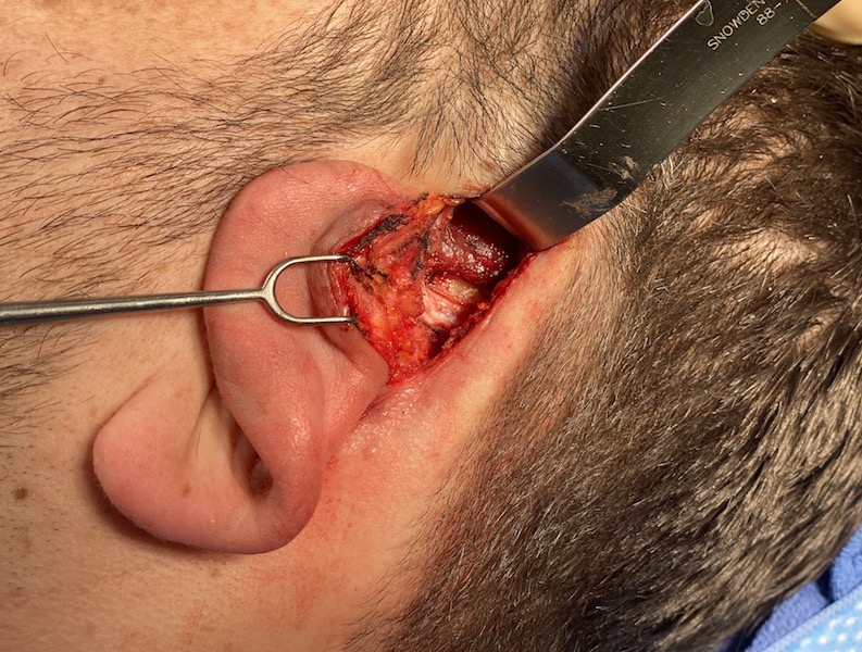 Posterior Muscle Exposure For Temporal Reduction Dr Barry Eppley