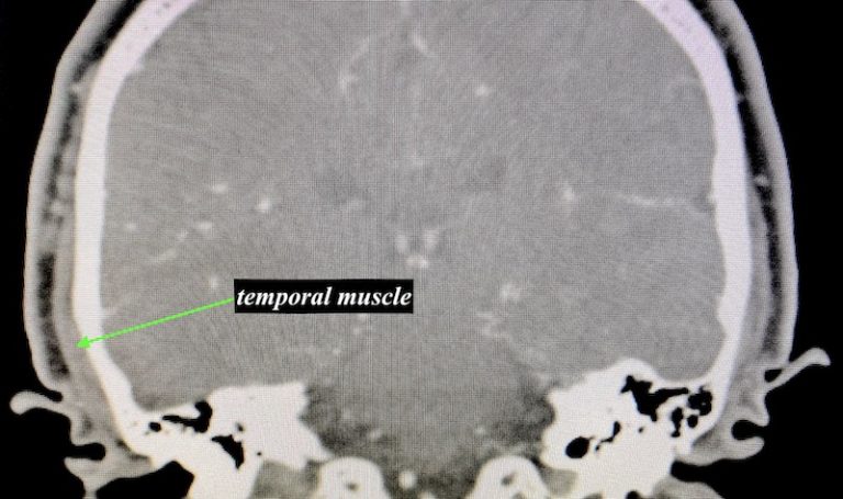 Plastic Surgery Case Study - Male Temporal Reduction for Head Width ...
