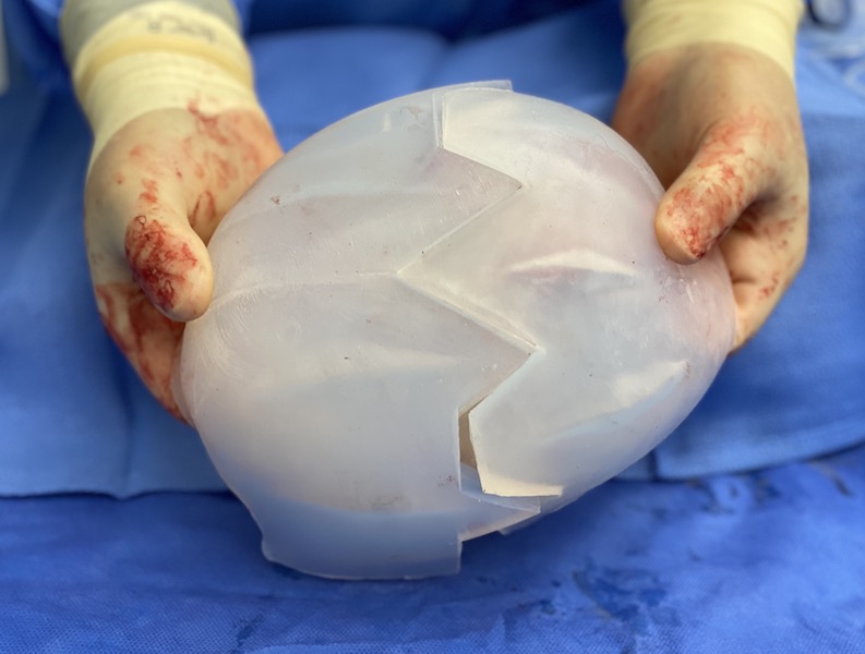 Plastic Surgery Case Study - Large Two-Piece Custom Skull Implant For ...