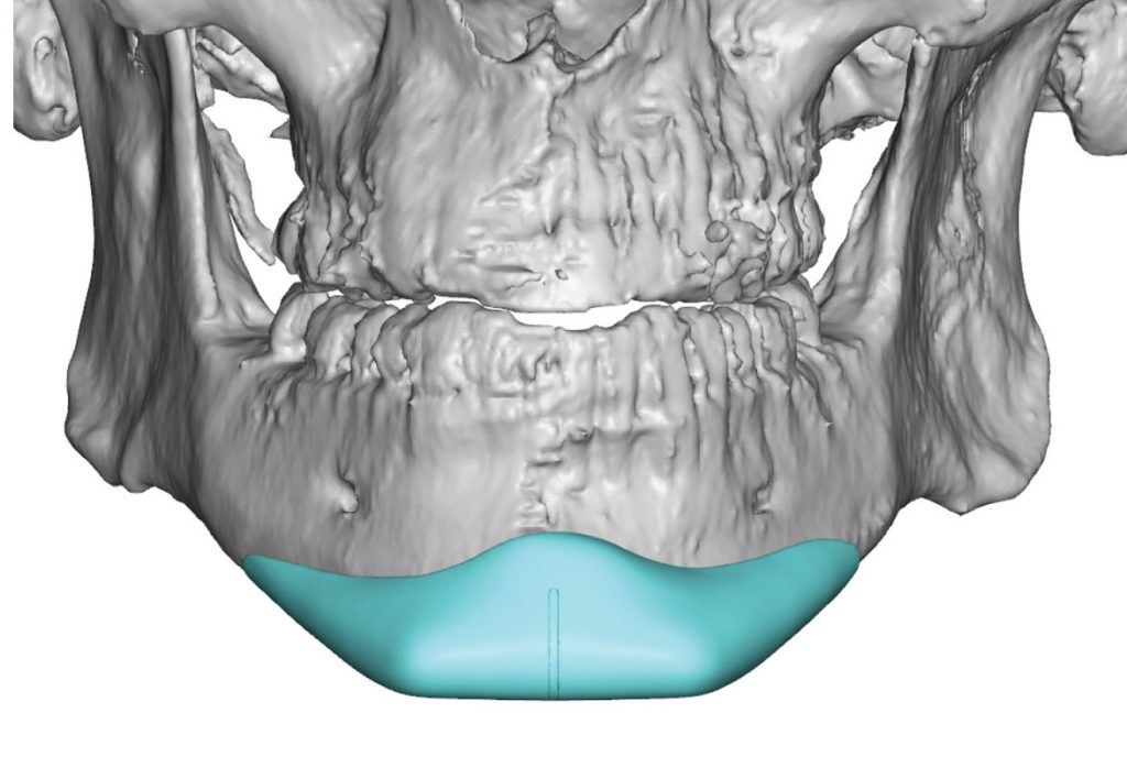 Design Considerations in Square Chin Implants - Explore Plastic Surgery