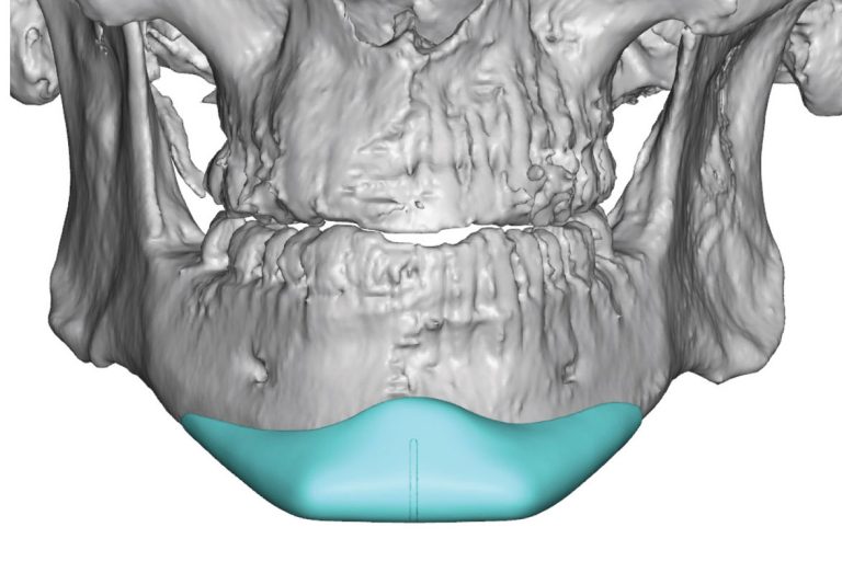 Design Considerations in Square Chin Implants - Explore Plastic Surgery