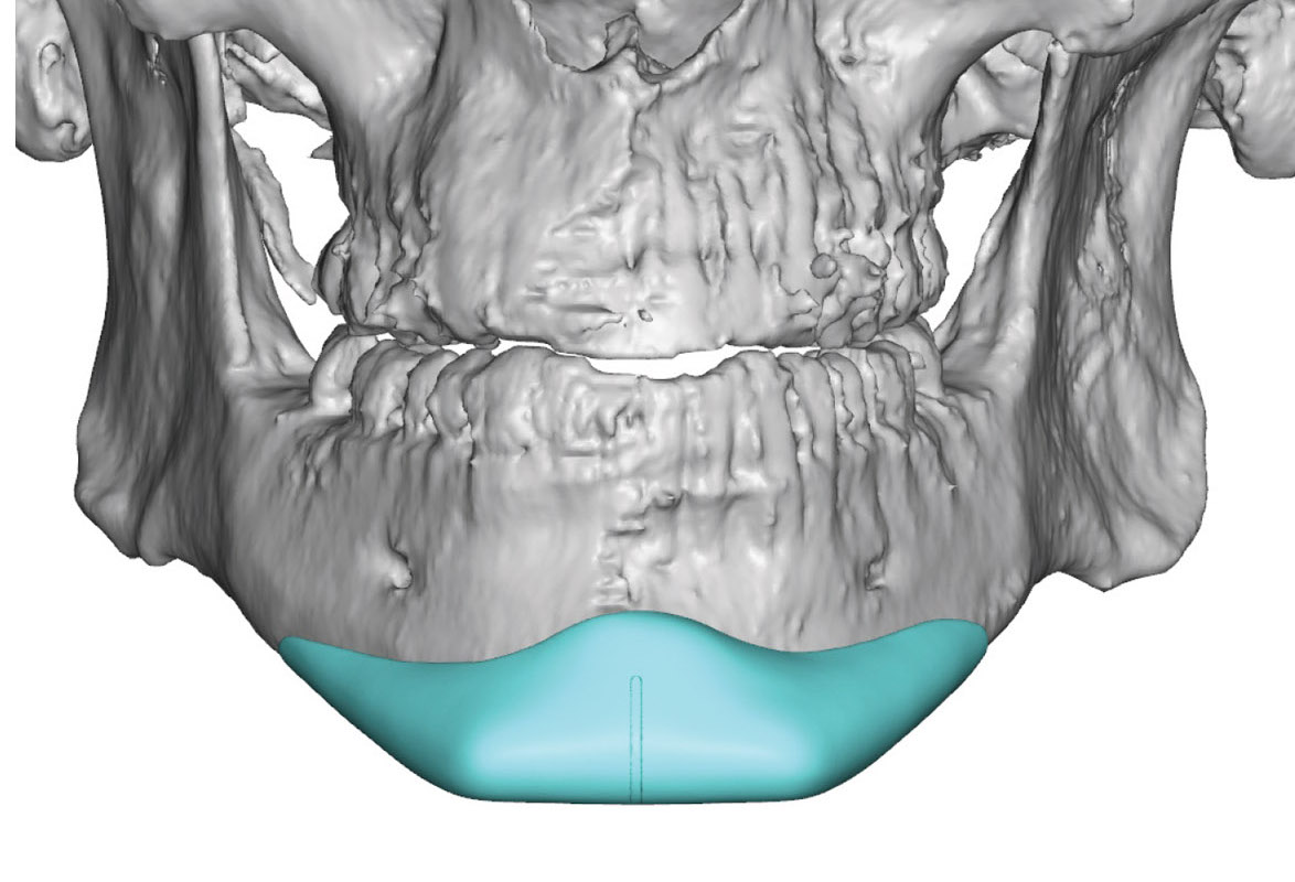 Design Considerations in Square Chin Implants - Explore Plastic Surgery