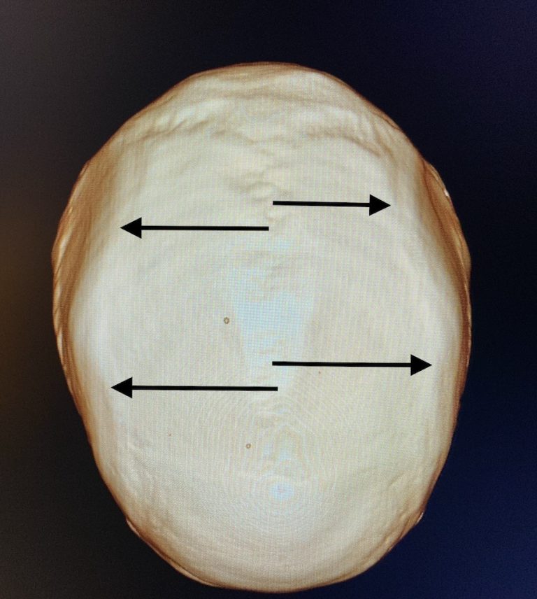 The Head Surface Concept in Aesthetic Skull Reshaping Surgery - Explore ...
