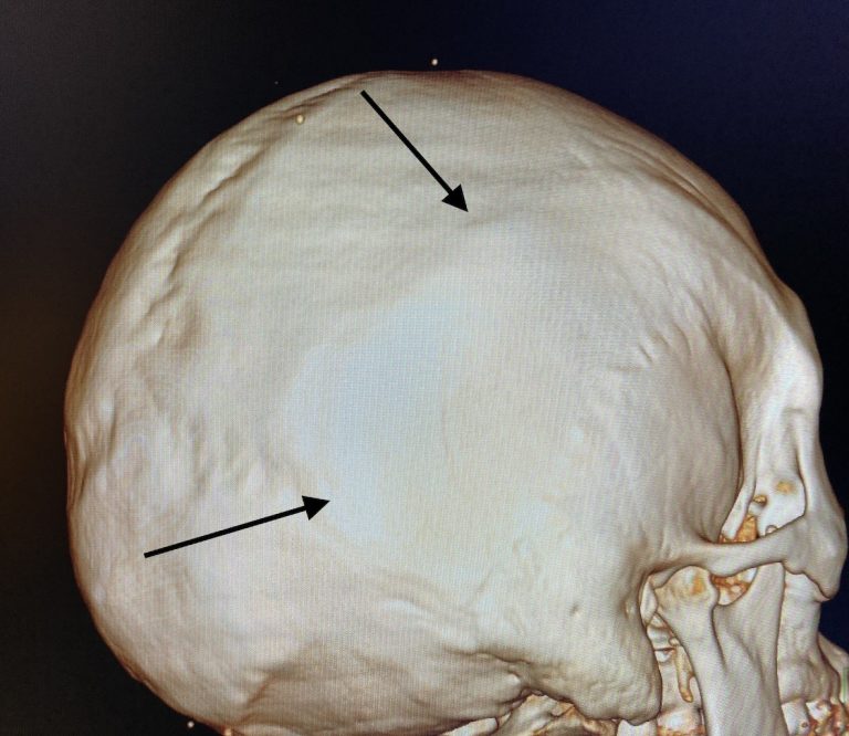The Head Surface Concept in Aesthetic Skull Reshaping Surgery - Explore ...