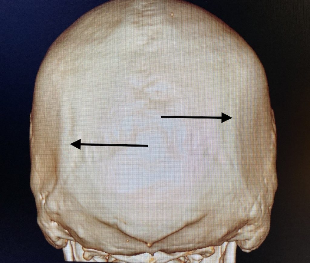 The Head Surface Concept in Aesthetic Skull Reshaping Surgery - Explore ...