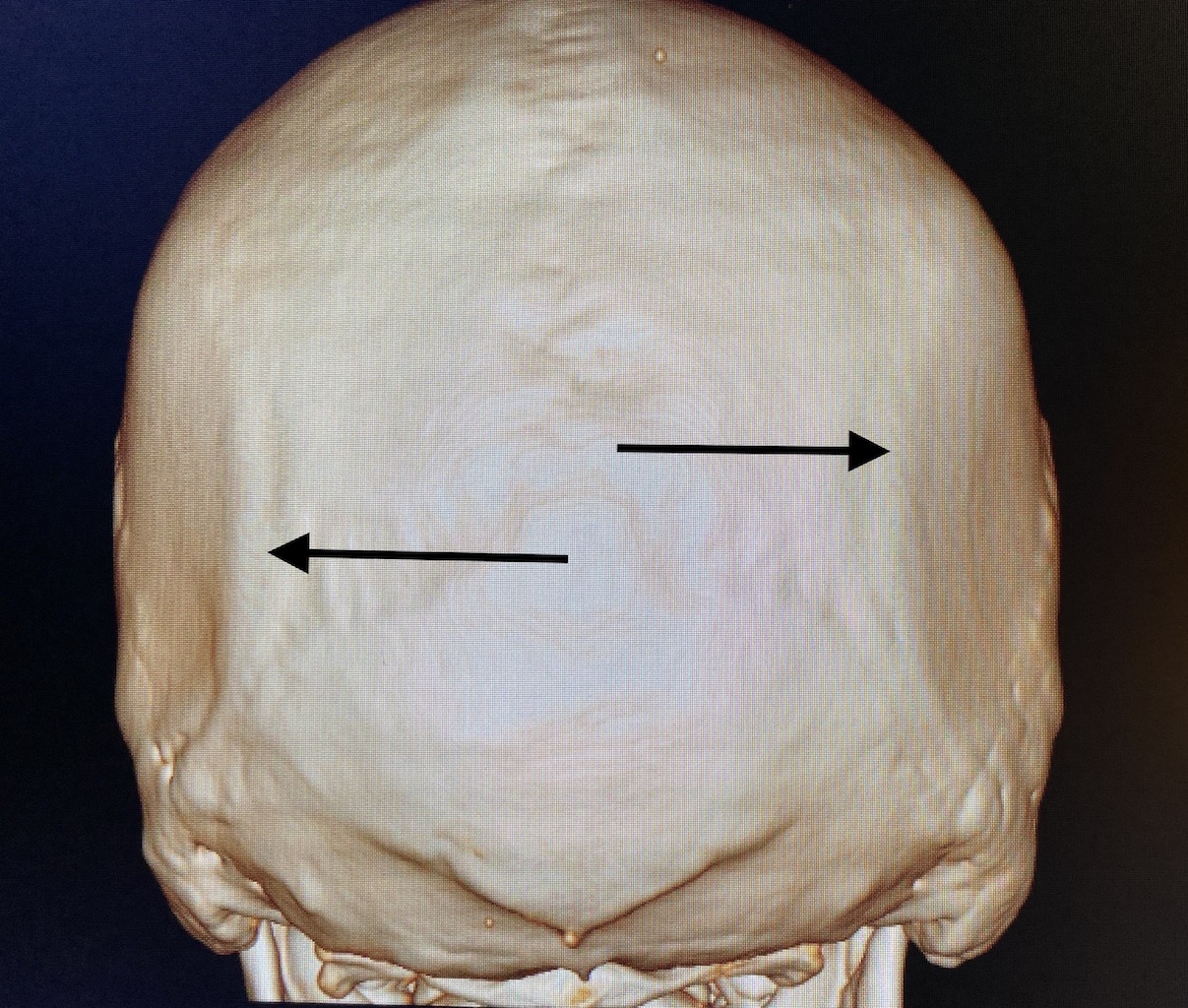 The Head Surface Concept in Aesthetic Skull Reshaping Surgery - Explore ...