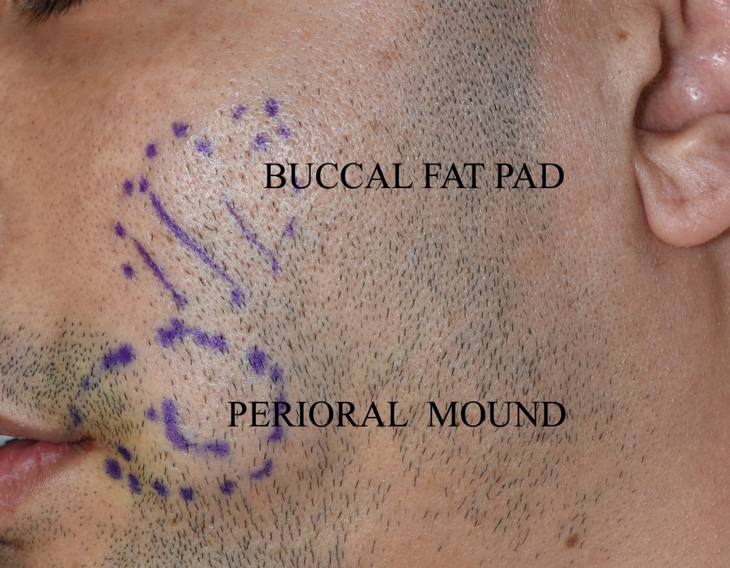 buccal fat vs periorla mounds - Explore Plastic Surgery