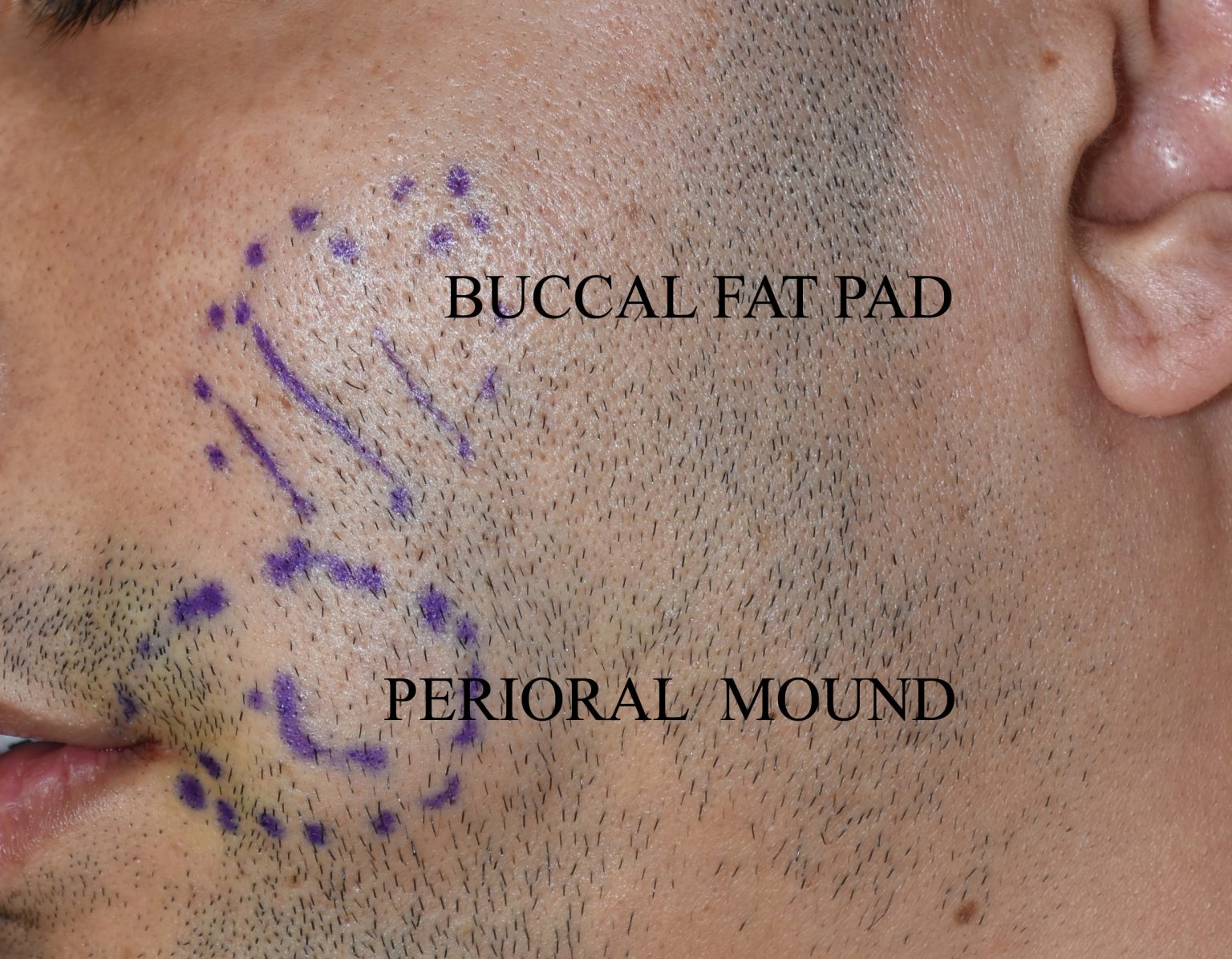 The Potential Role of Buccinator Myectomies in Cheek Slimming Surgery ...