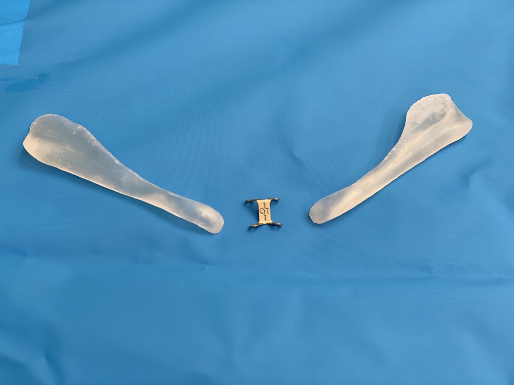 combined sliding genioplasty and custom jaw angle implants devices DR ...