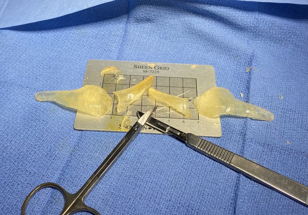 Secondary Modification of Custom Infraorbital-Malar Implants for the ...