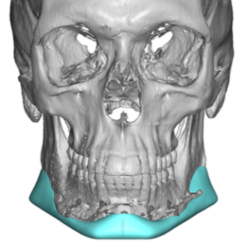 Plastic Surgery Case Study - Custom Jawline Implant After Chin Wing ...