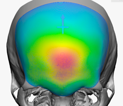 female custom forehead design color thicknesses Dr Barry Eppley ...
