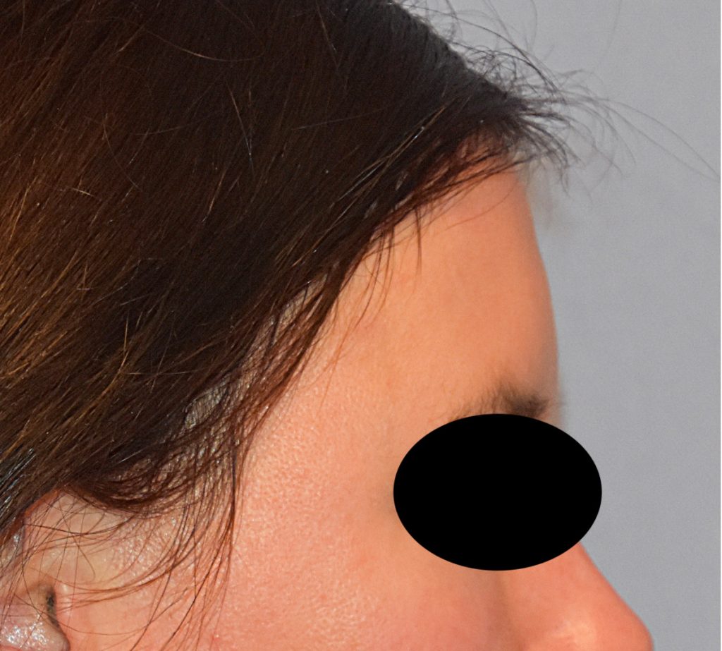 Plastic Surgery Case Study - Female Upper Third of Face Feminization ...