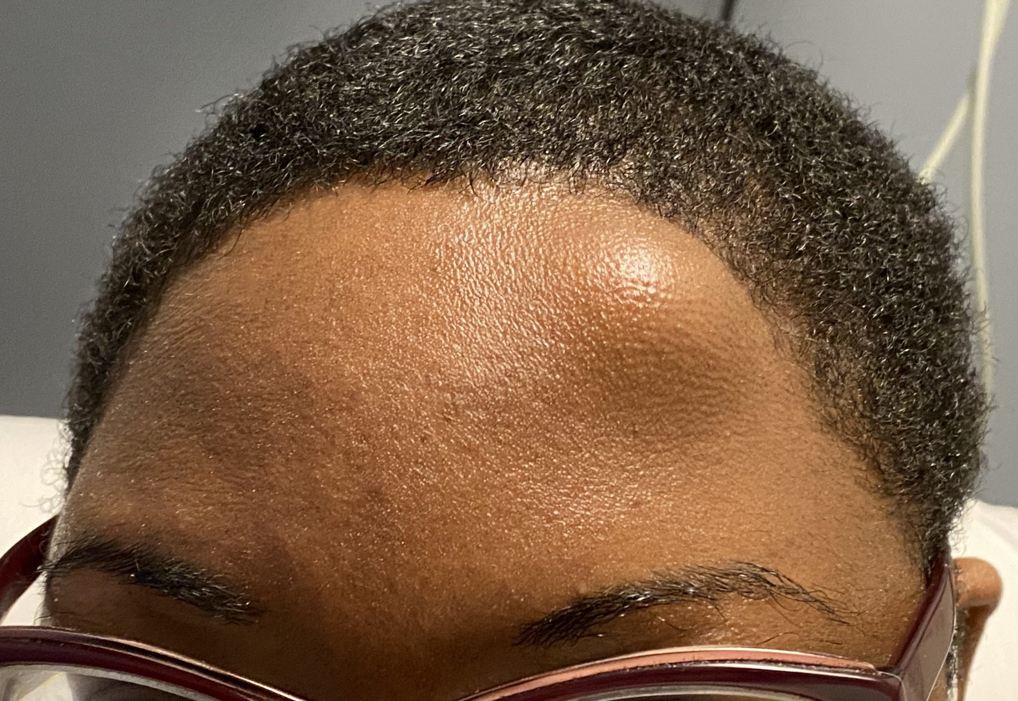 Plastic Surgery Case Study - Saw Blade Excision of Large Forehead ...