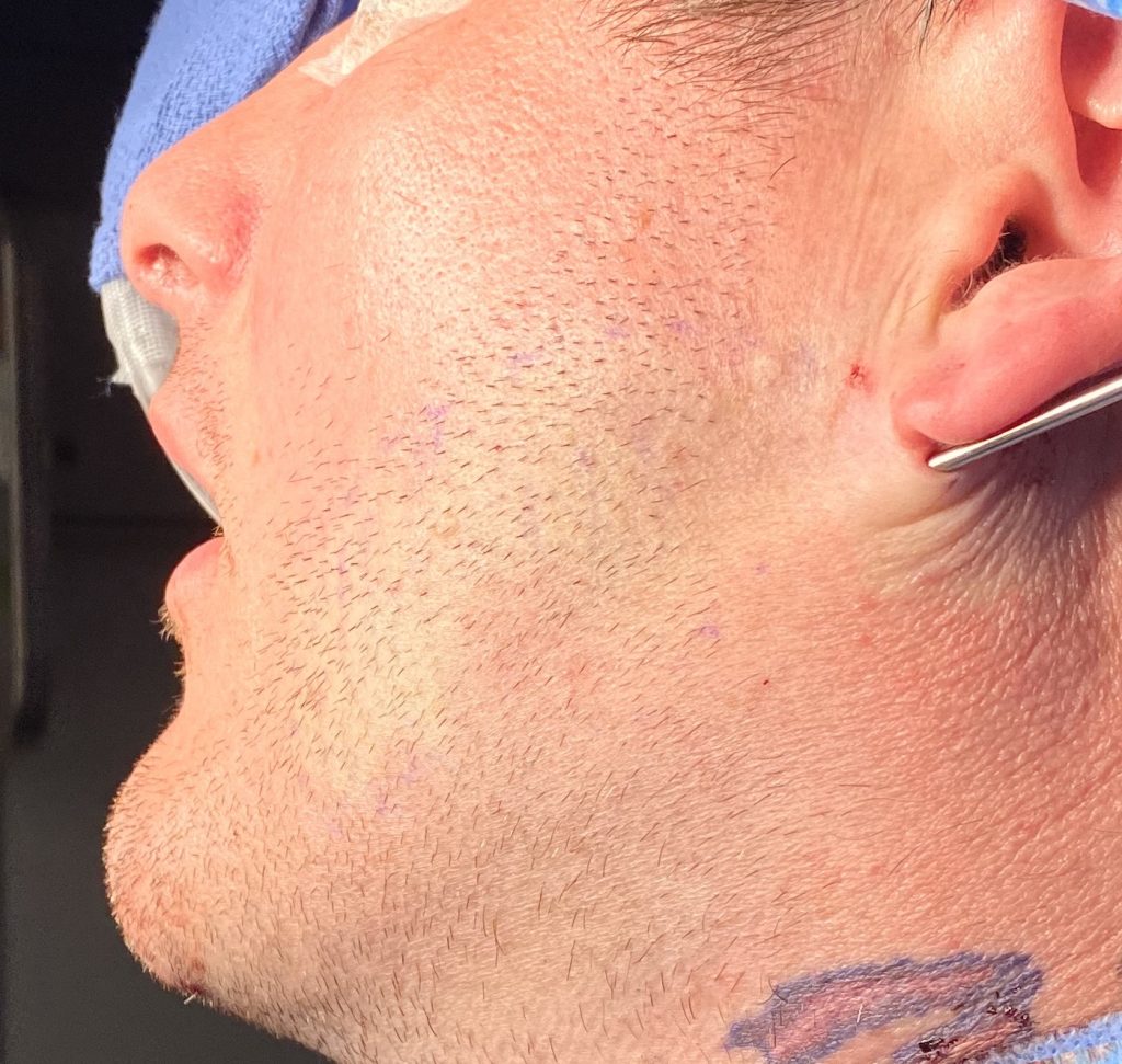 OR Snapshots - Lateral Facial Liposuction - Explore Plastic Surgery