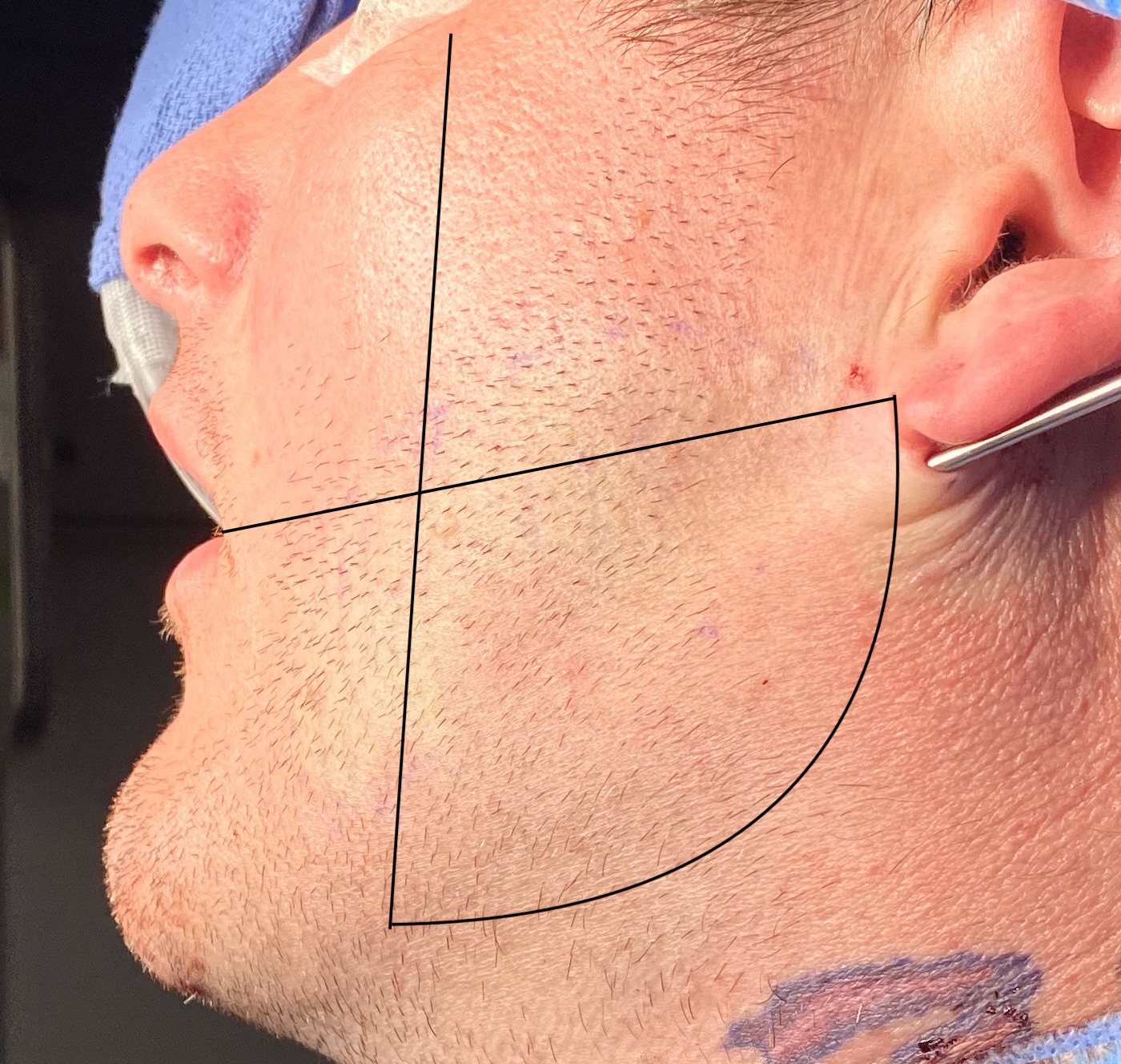 lateral facial liposuction Dr Barry Eppley Indianapolis 2 - Explore ...