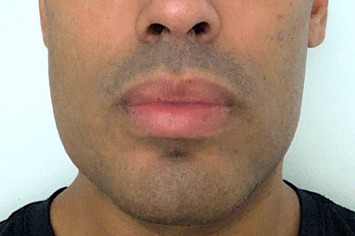 Plastic Surgery Case Study - An Autologous-Implant Approach to Jawline ...