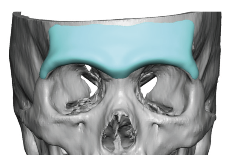Custom Brow Bone Implant Designs Based On Anatomic Brow Bone Topography ...